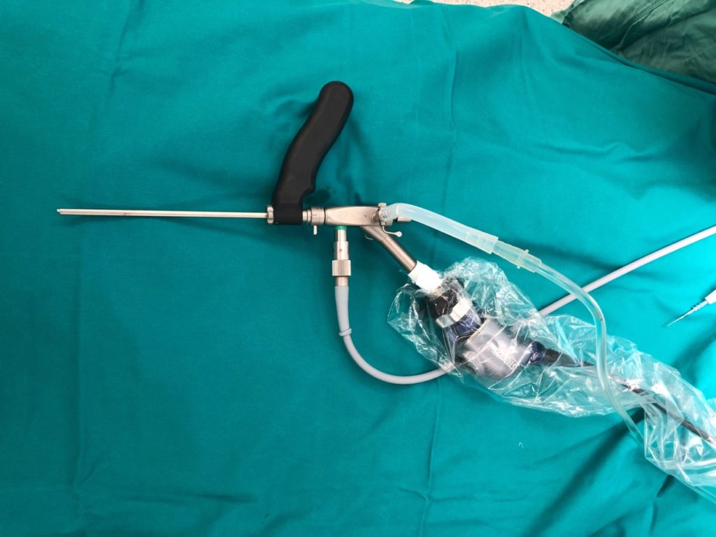 Κύστη κόκκυγα, θεραπεία χωρίς νυστέρι, ανώδυνα, ενδοσκοπικά